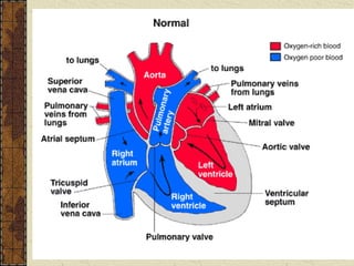 Transposition of the great arteries | PPT