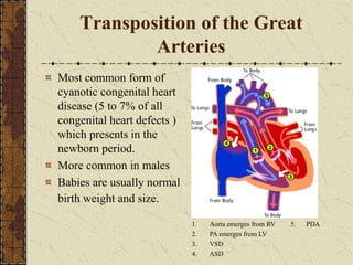 Transposition of the great arteries | PPT