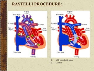 Transposition of the great arteries | PPT