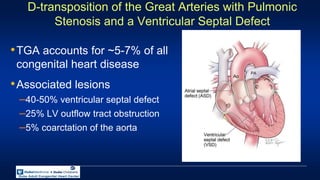 Pulmonary Hypertension in an Adult with Complex Congenital Heart ...