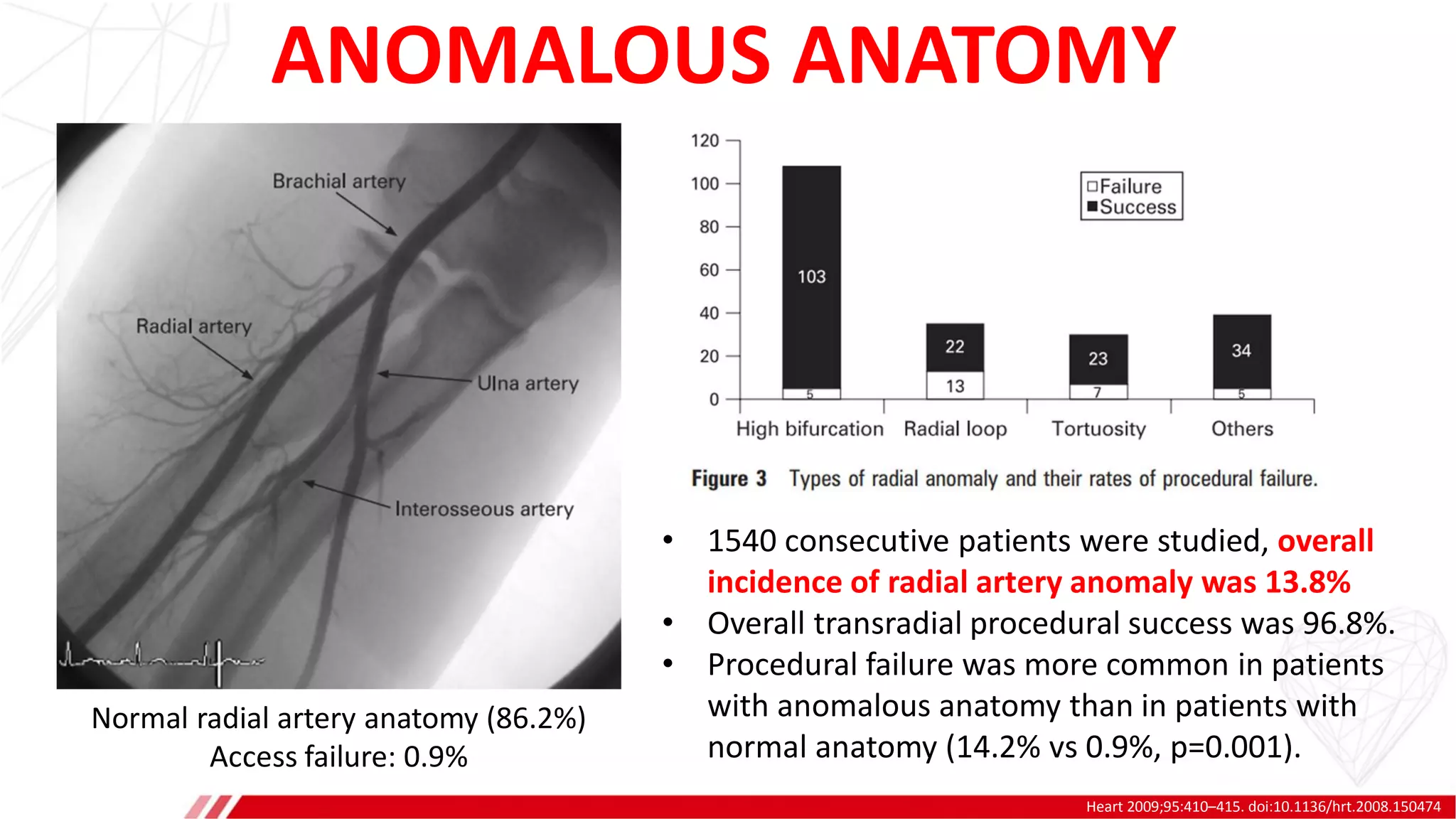 TRANSRADIAL ACCESS.pdf