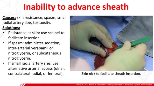 TRANSRADIAL ACCESS.pdf