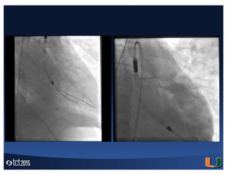 Cohen MG 2016 Transradial primary PCI in shock | PPT