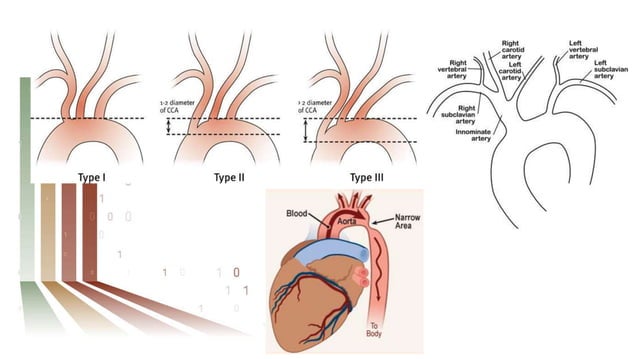 transradial approach for neurointerventions.pptx