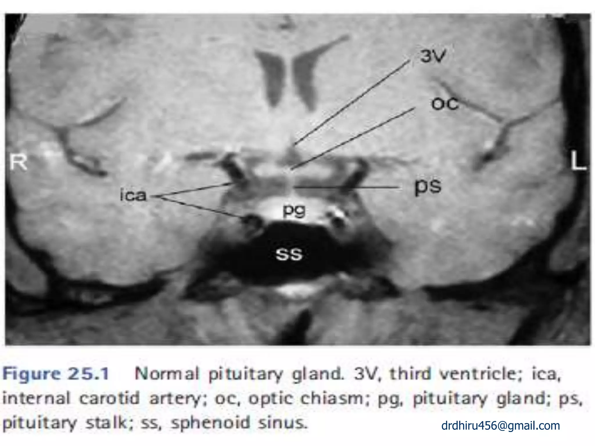 Transsphenoidal hypophysectomy (by drdhiru456) | PPTX