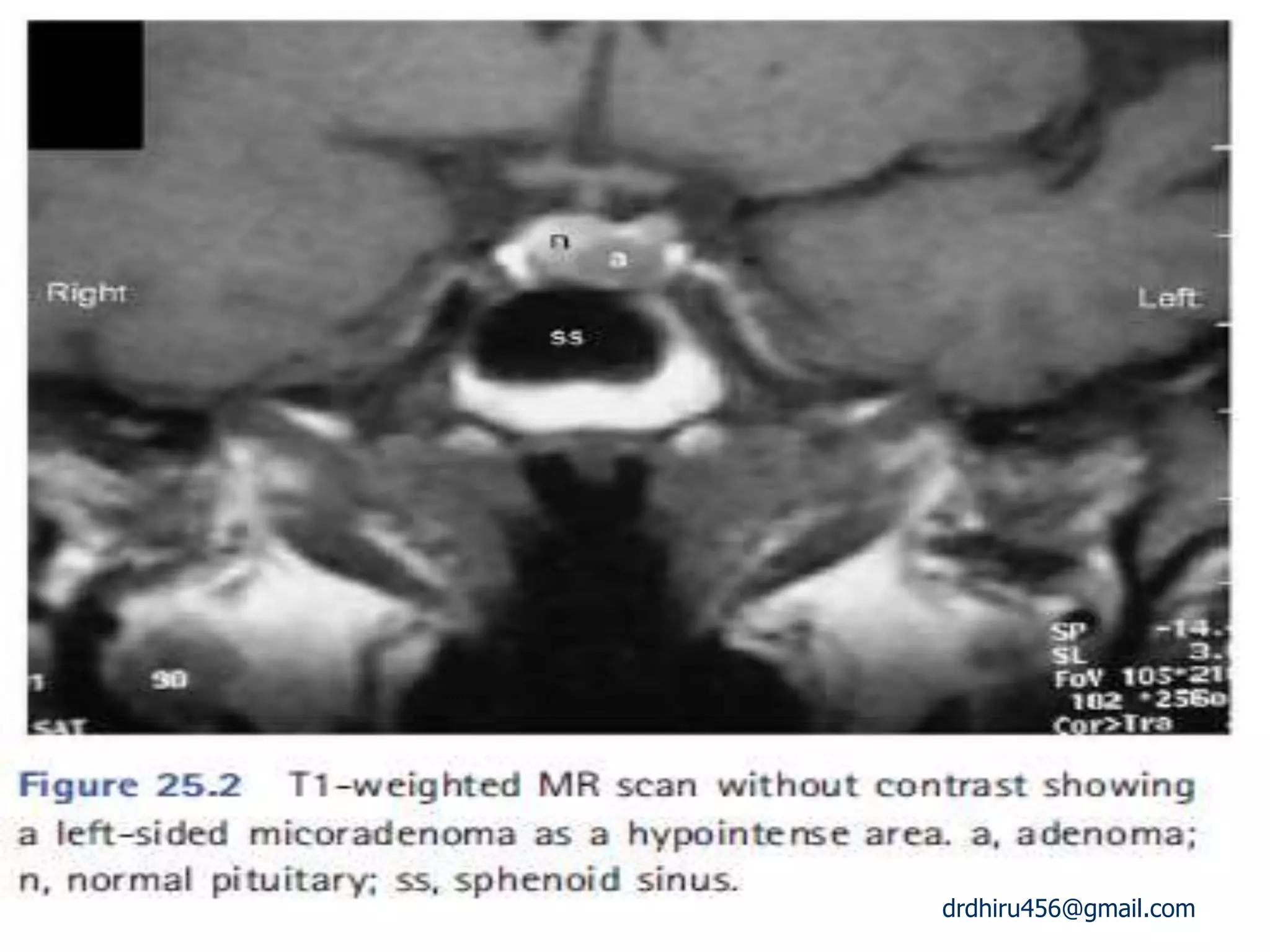 Transsphenoidal hypophysectomy (by drdhiru456) | PPTX
