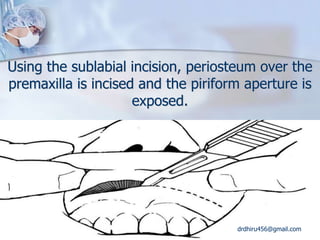 Transsphenoidal hypophysectomy (by drdhiru456) | PPTX