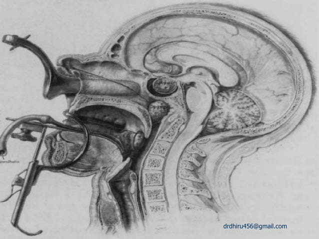 Transsphenoidal hypophysectomy (by drdhiru456) | PPT