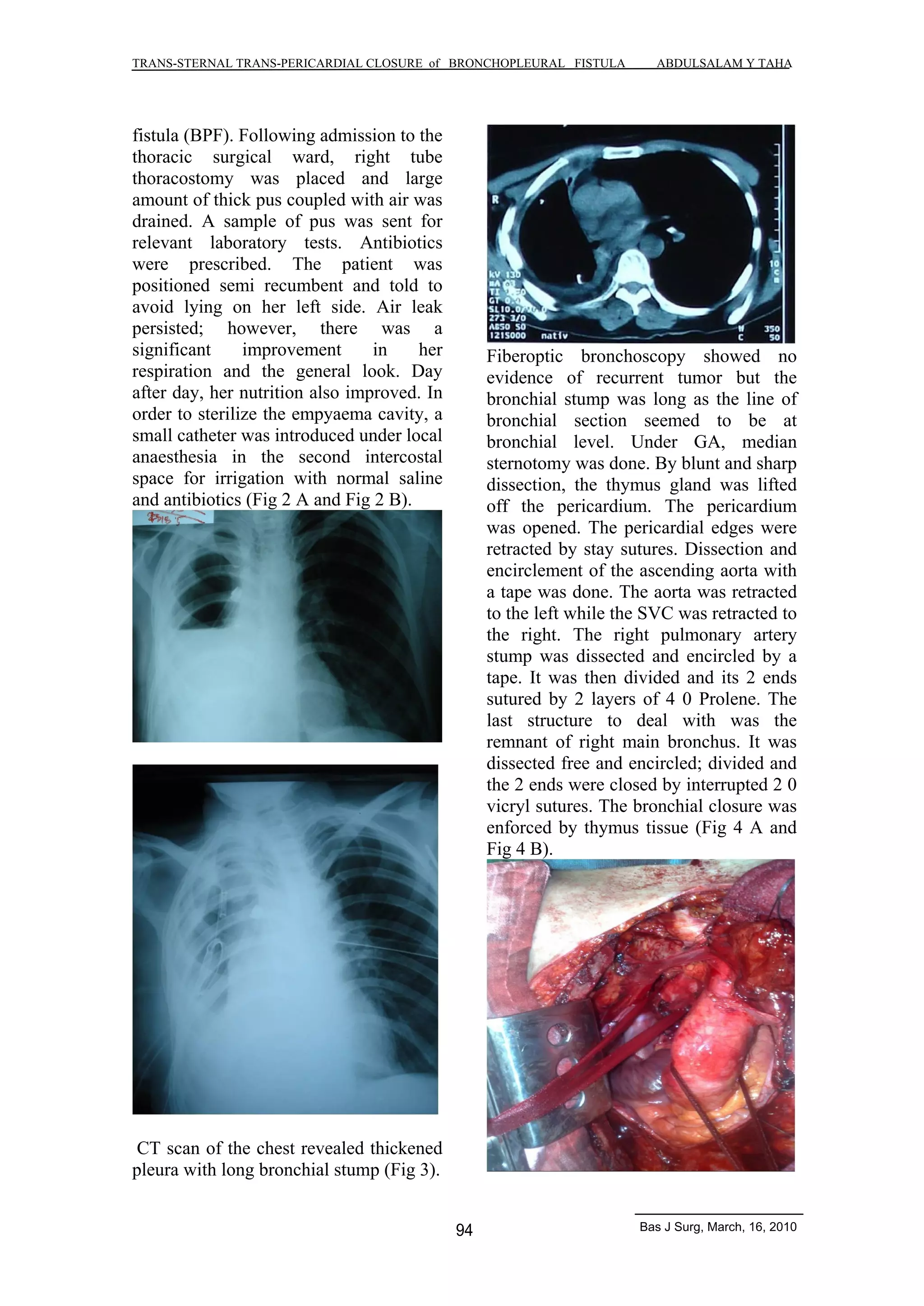 Trans sternal trans pericardial closure of post pneumonectomy ...