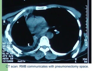 Transsternsl transpericardial closure of postpneumonectomy ...