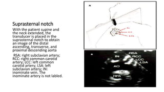 Transthoracic Echocardiogram, 3D, Doppler, TEE.pptx