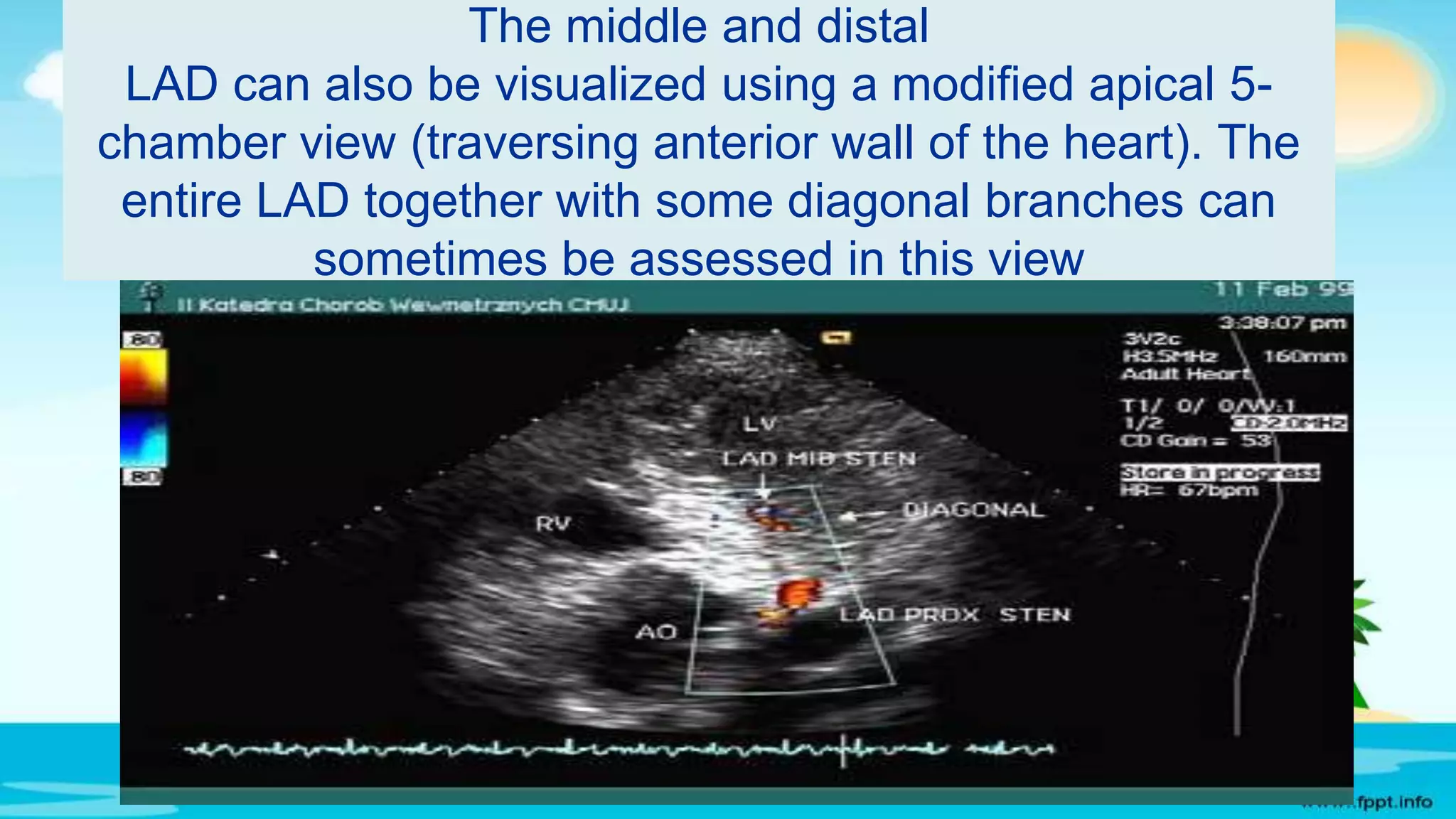 Transthoracic echocardiography in coronary artery disease | PPTX