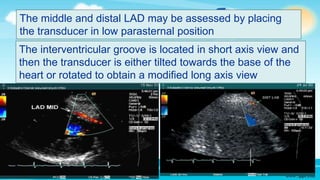 Transthoracic echocardiography in coronary artery disease | PPTX