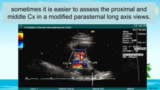 Transthoracic echocardiography in coronary artery disease | PPTX