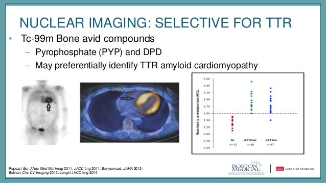 Transthyretin(TTR) amyloidosis