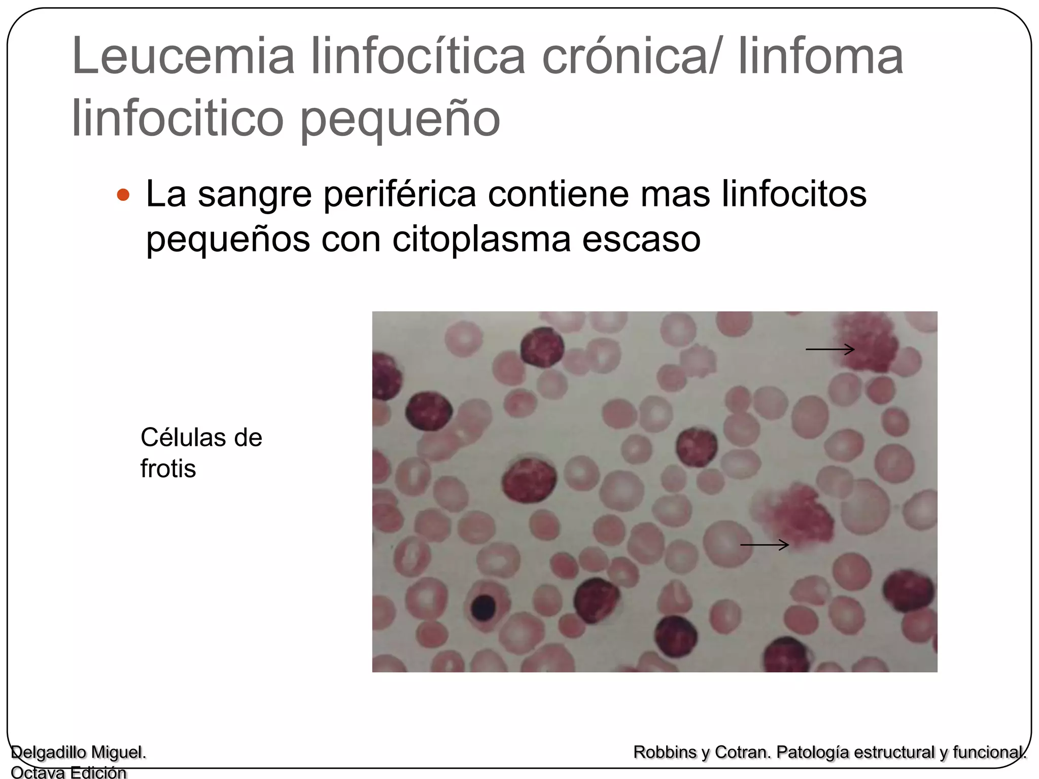 Enfermedades de los leucocitos, ganglios linfaticos, bazo y timo | PPTX