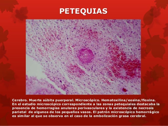 Equimosis Bucal