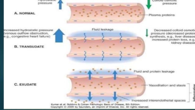 Transudate vs exudates | PPTX | Lung and Respiratory Health | Diseases ...