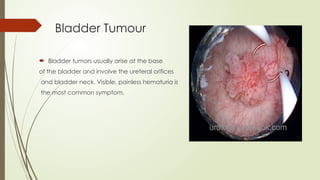 Transurethral Resection of Bladder Tumour (TURBT) and Pyeloplasty | PPTX