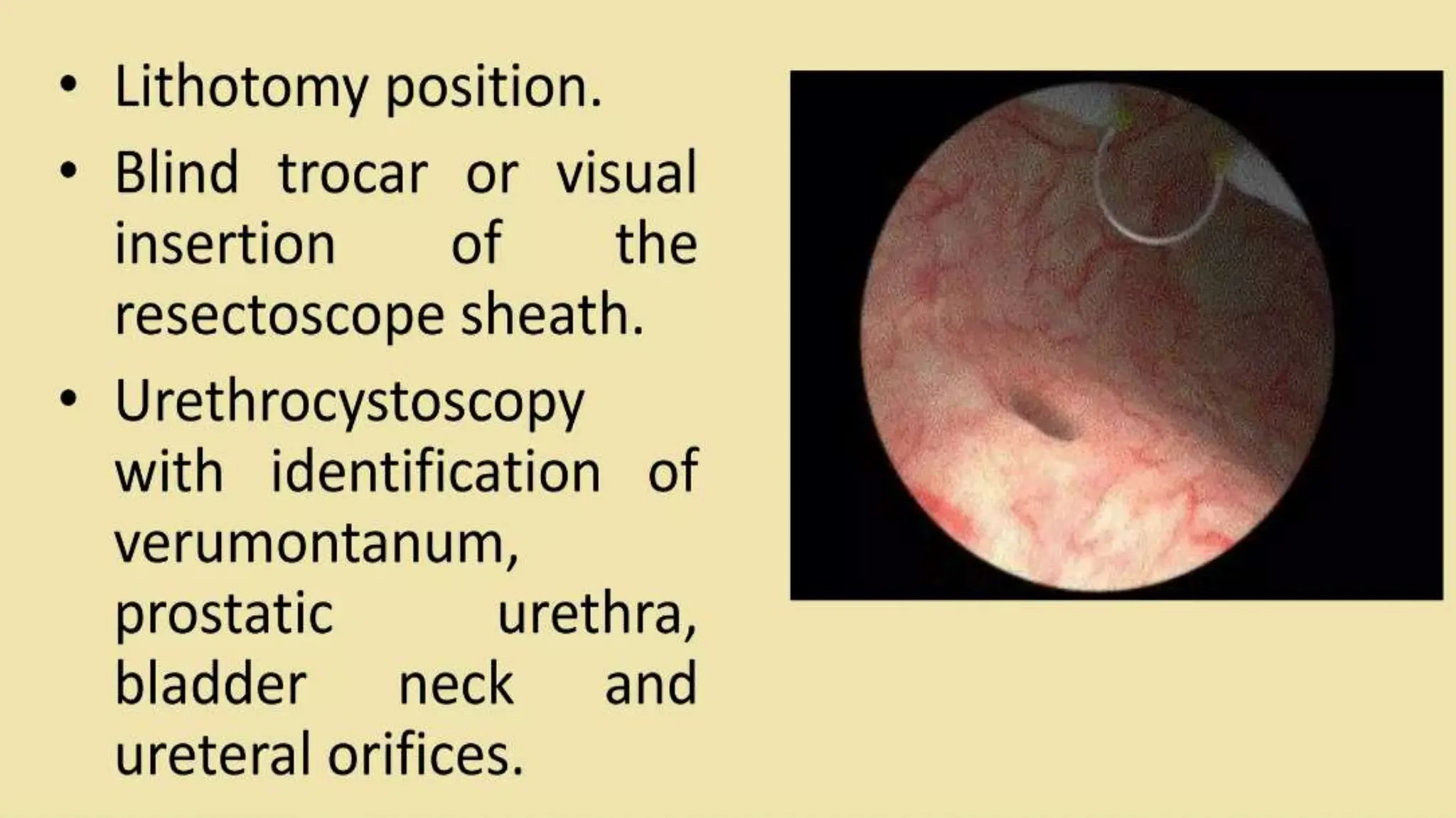 TRANSURETHRAL RESECTION OF PROSTATE.pptx