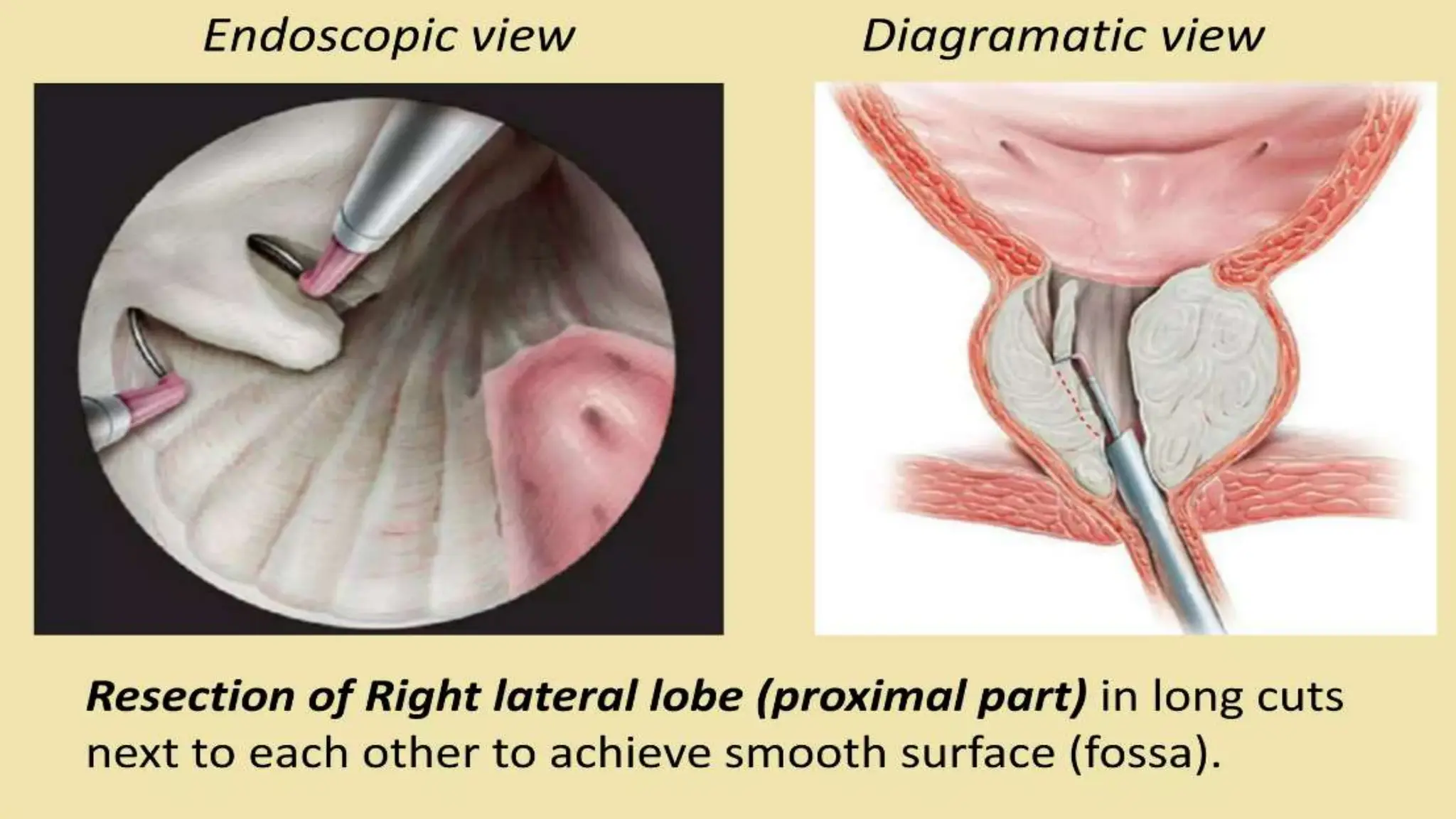 TRANSURETHRAL RESECTION OF PROSTATE.pptx