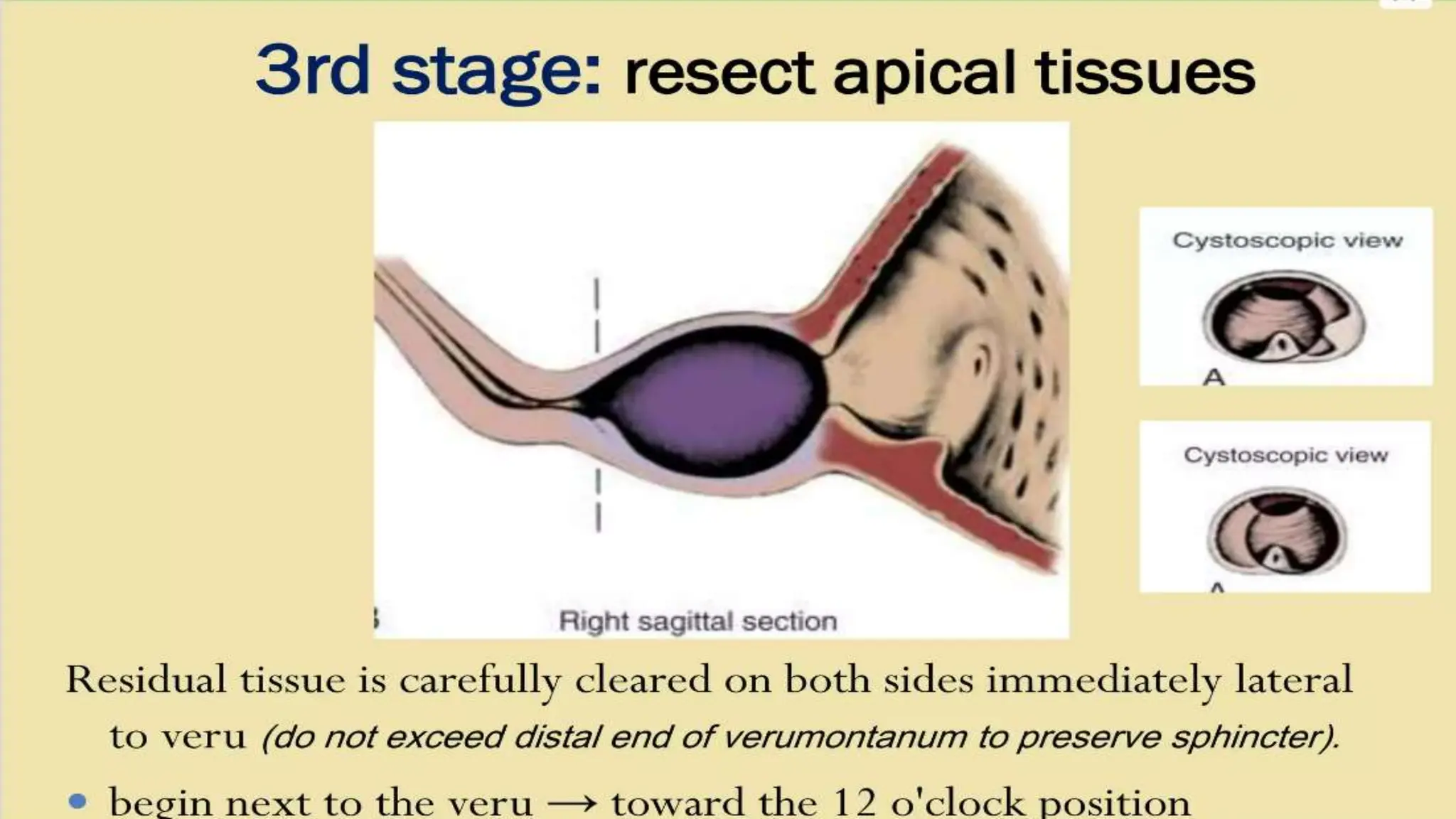 TRANSURETHRAL RESECTION OF PROSTATE.pptx