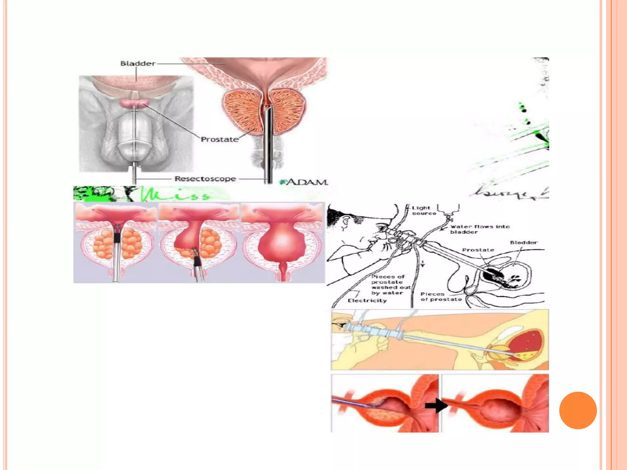 Nursing Transurethral Resection Of The Prostate Ppt