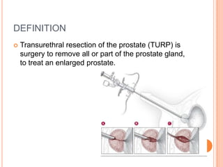 Nursing Transurethral Resection of the Prostate | PPTX