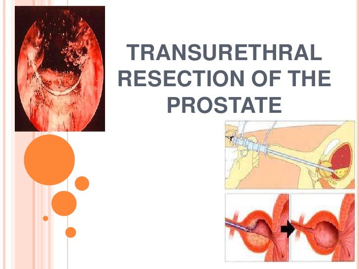 Nursing Transurethral Resection Of The Prostate