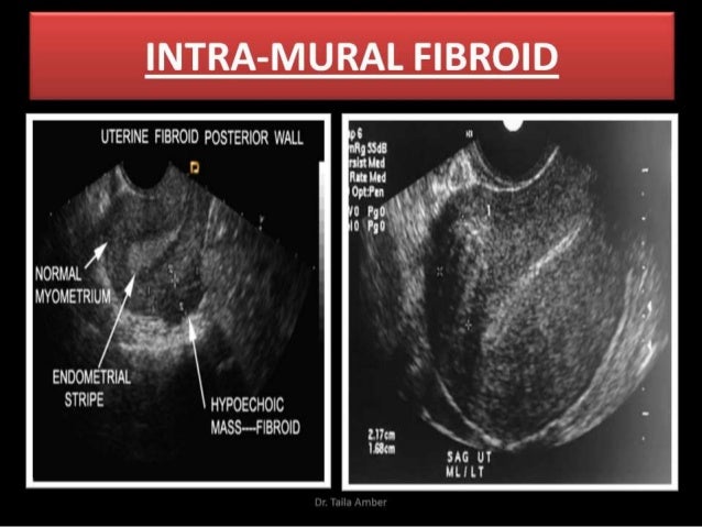 Transvaginal Ultrasound Presentation By Dr Taila Amber