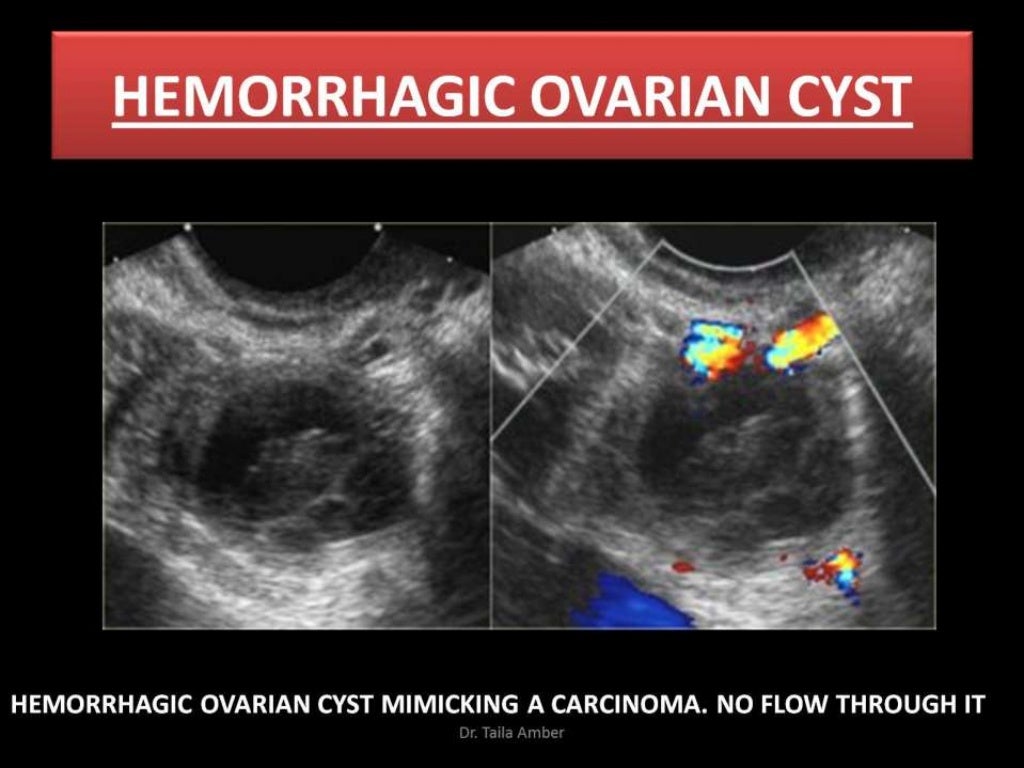 Transvaginal Ultrasound Presentation By Dr Taila Amber