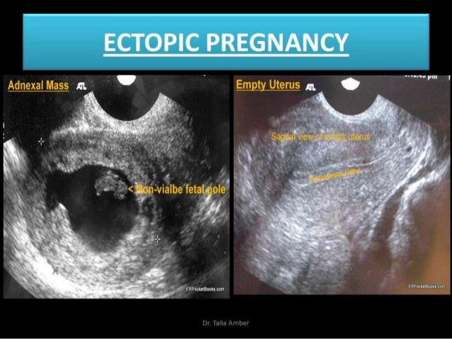 Normal Vs Ectopic Pregnancy