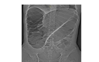 Transverse colon volvulus | PPTX