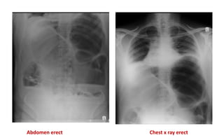 Transverse colon volvulus | PPTX