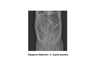 Transverse colon volvulus | PPTX