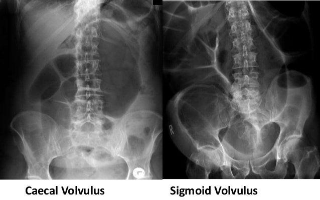 Transverse colon volvulus