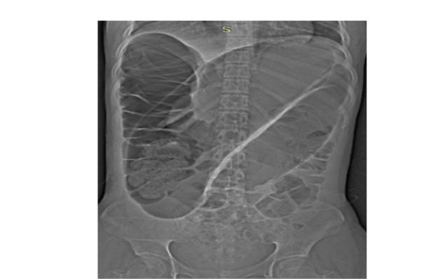 Transverse colon volvulus