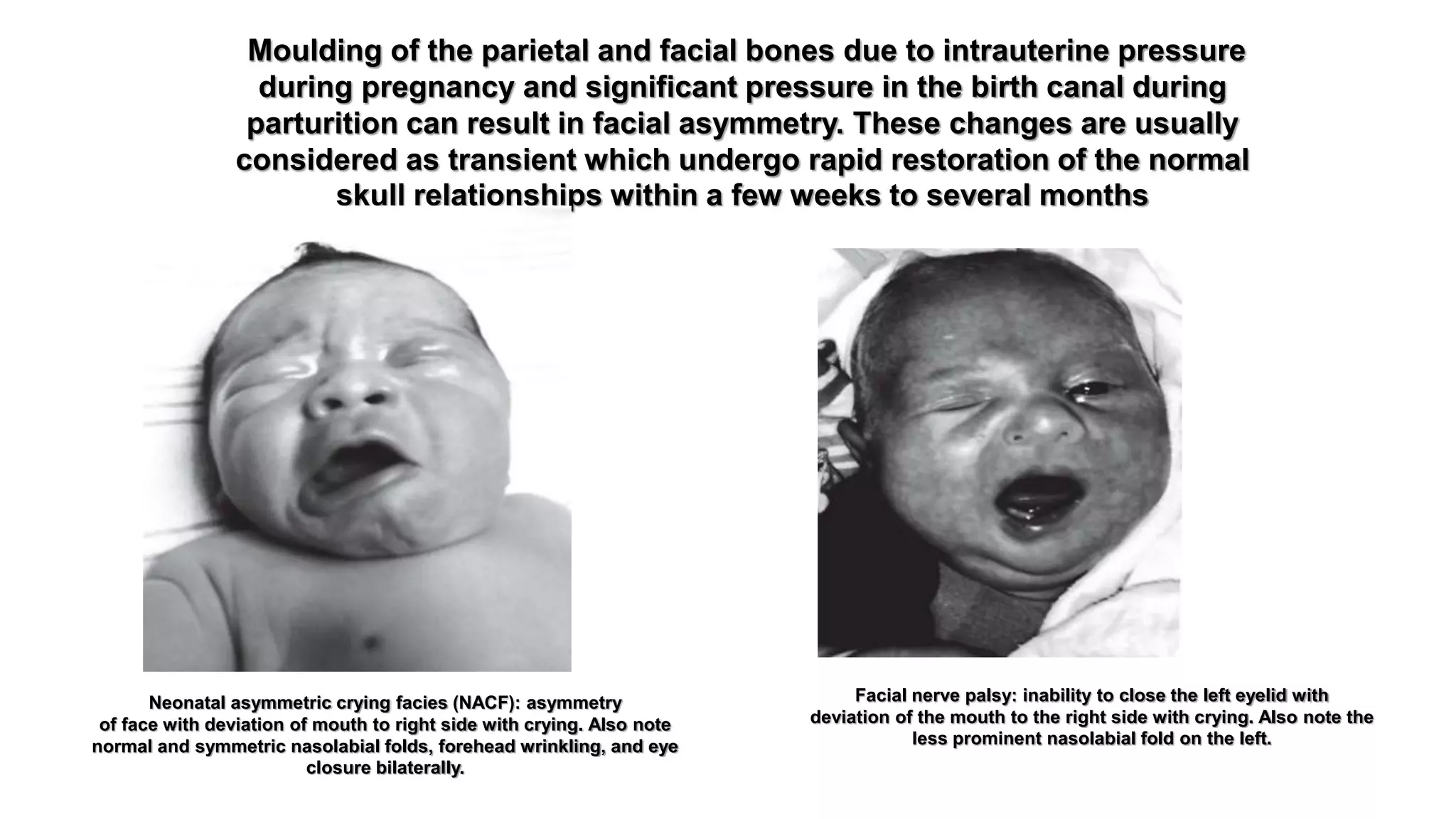 Transverse discrepancies | PPTX