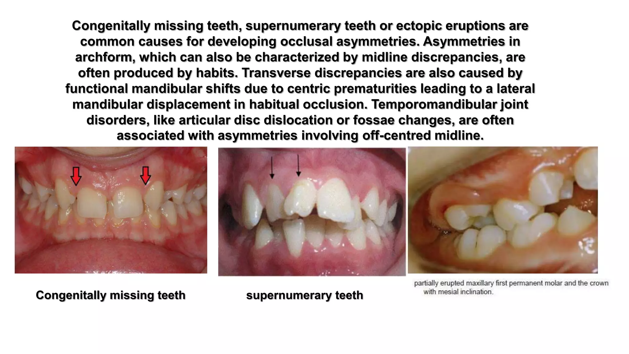Transverse discrepancies | PPTX