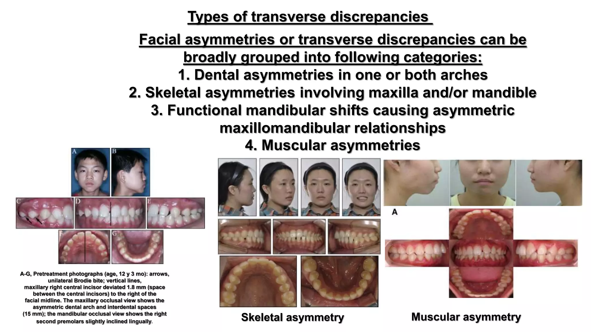 Transverse discrepancies | PPTX