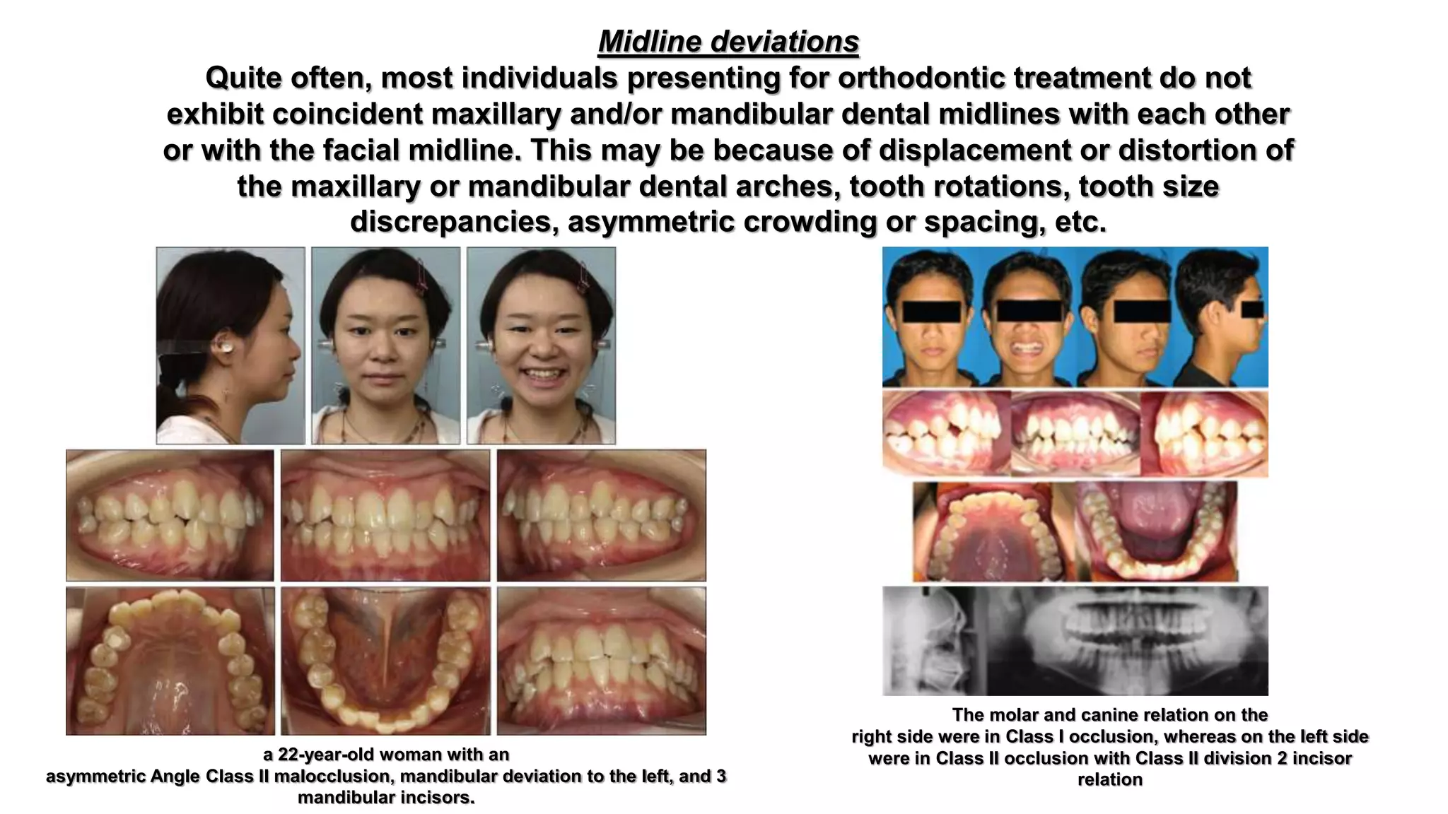 Transverse discrepancies | PPTX