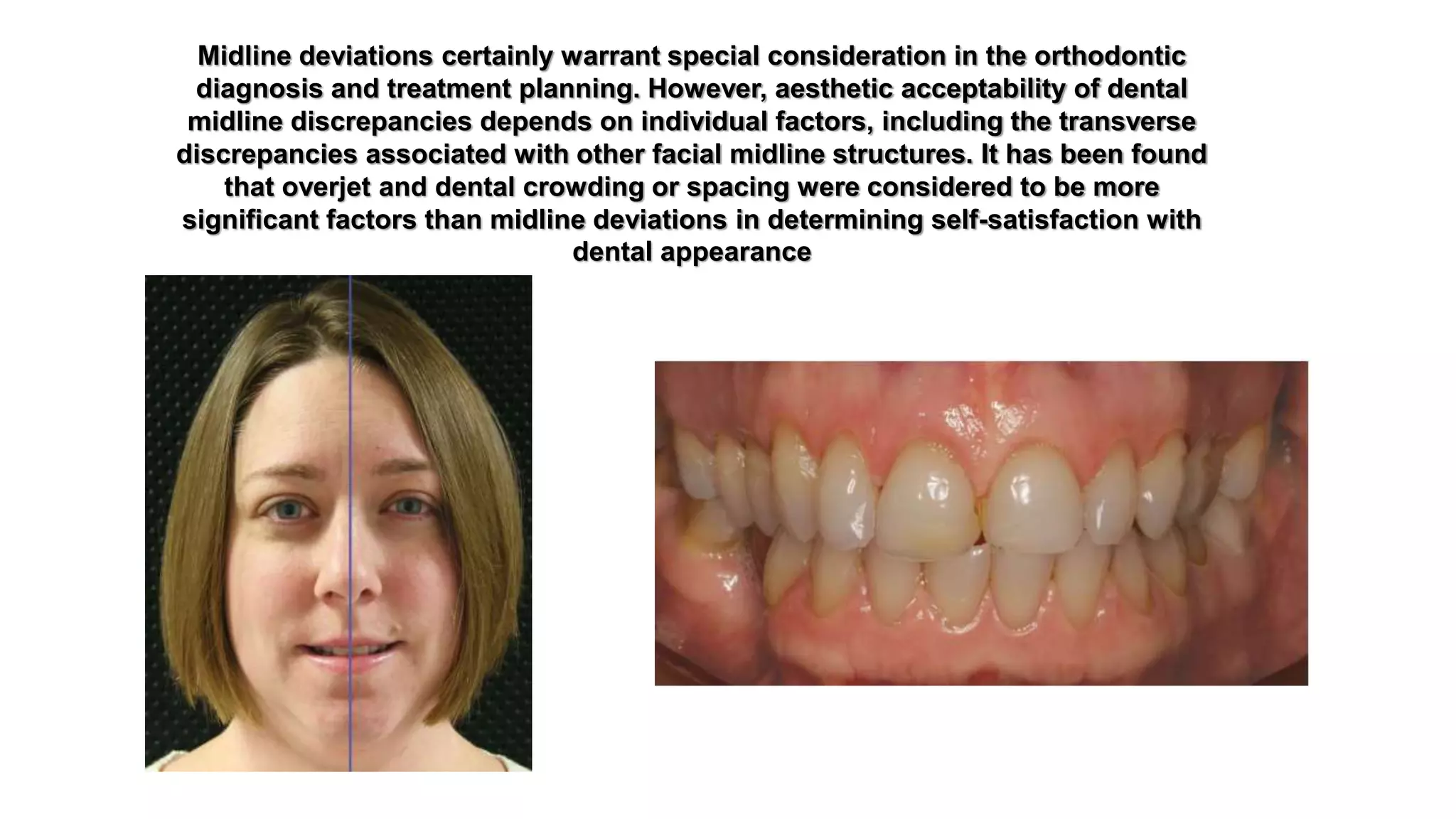 Transverse discrepancies | PPTX