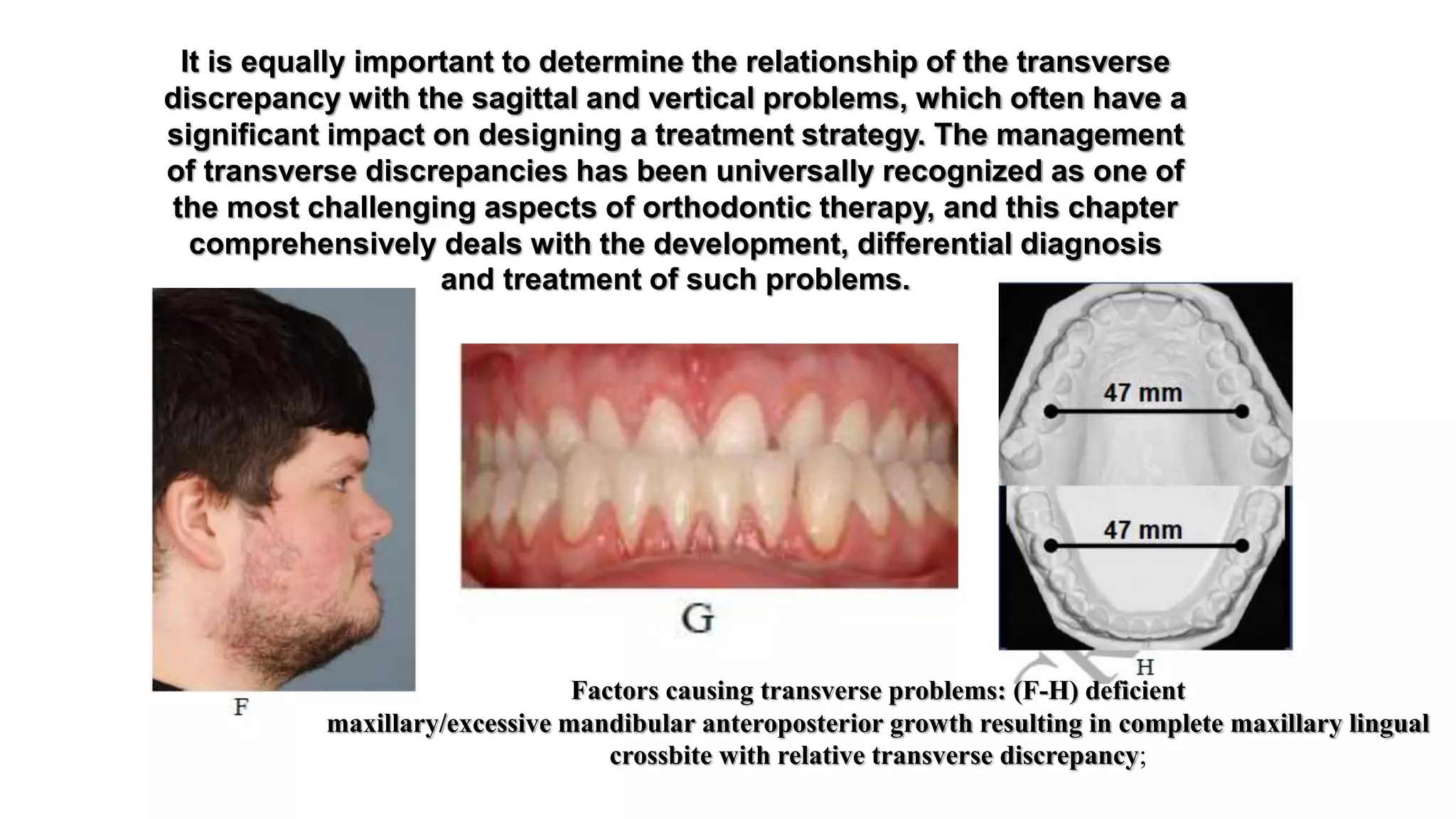 Transverse discrepancies | PPTX