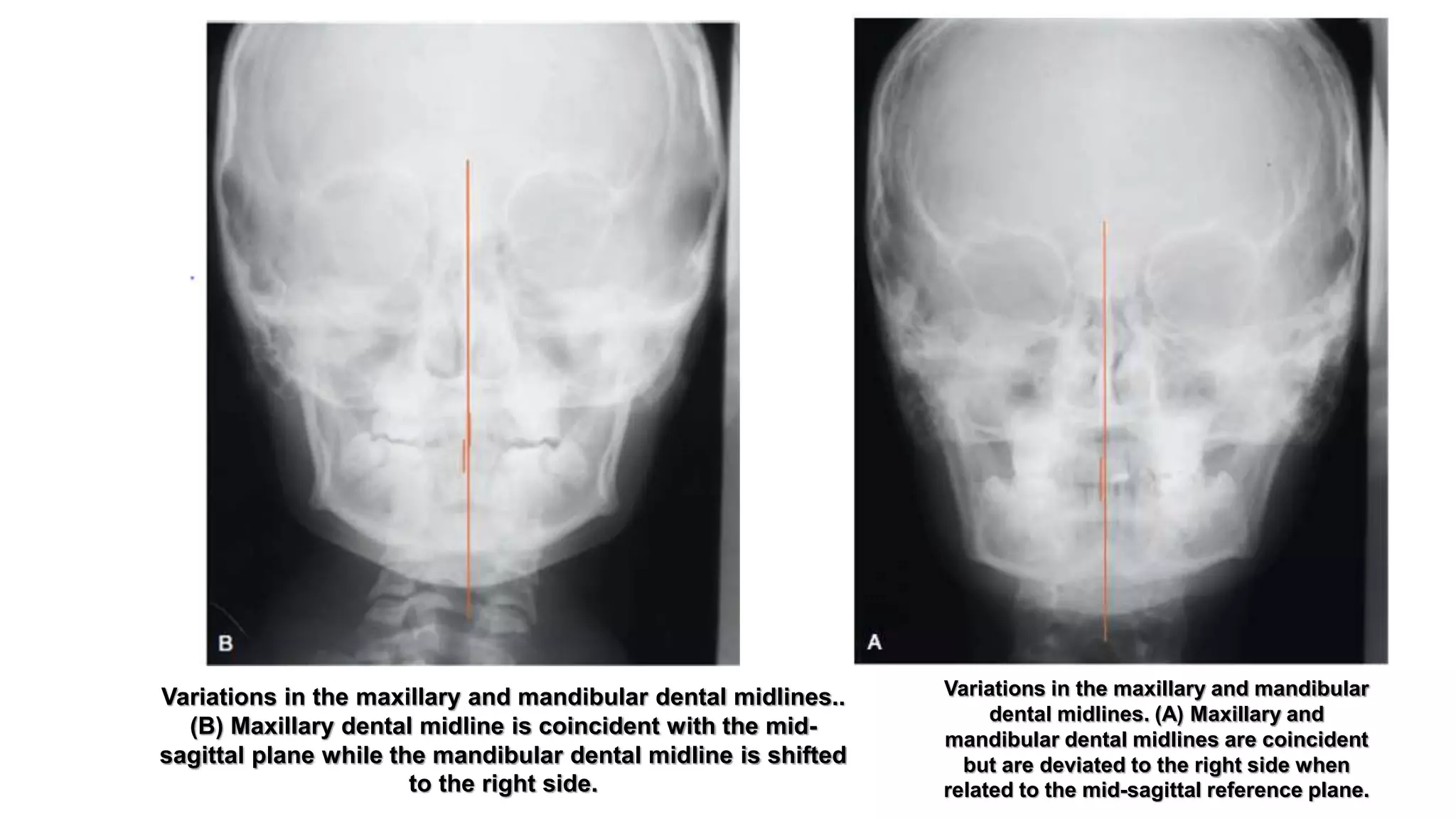 Transverse discrepancies | PPTX