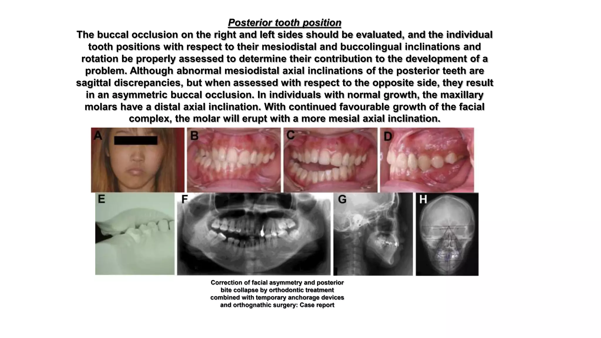 Transverse discrepancies | PPTX