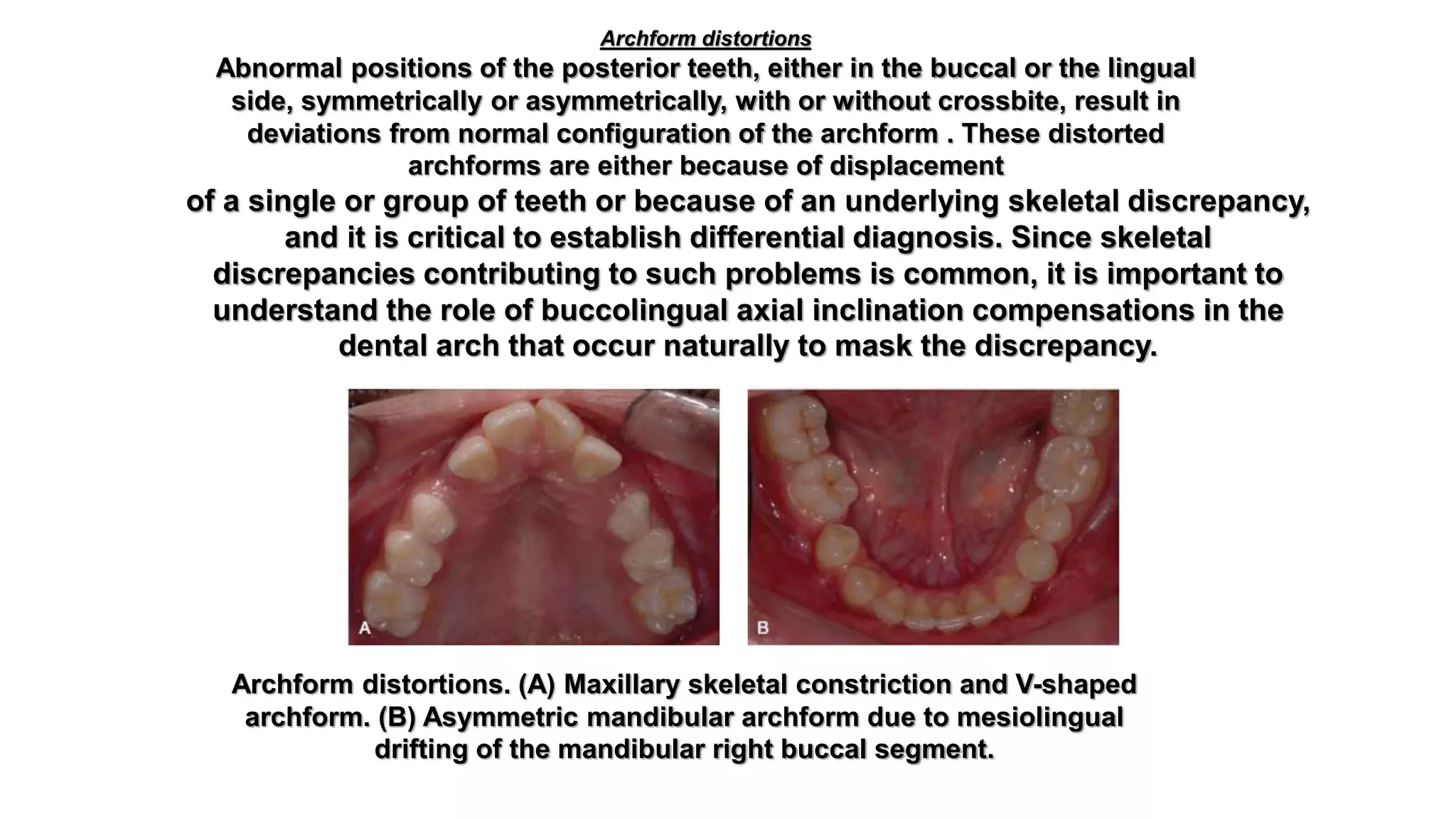 Transverse discrepancies | PPTX