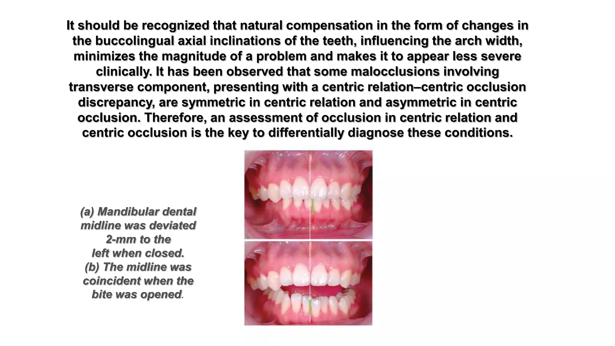 Transverse discrepancies | PPTX