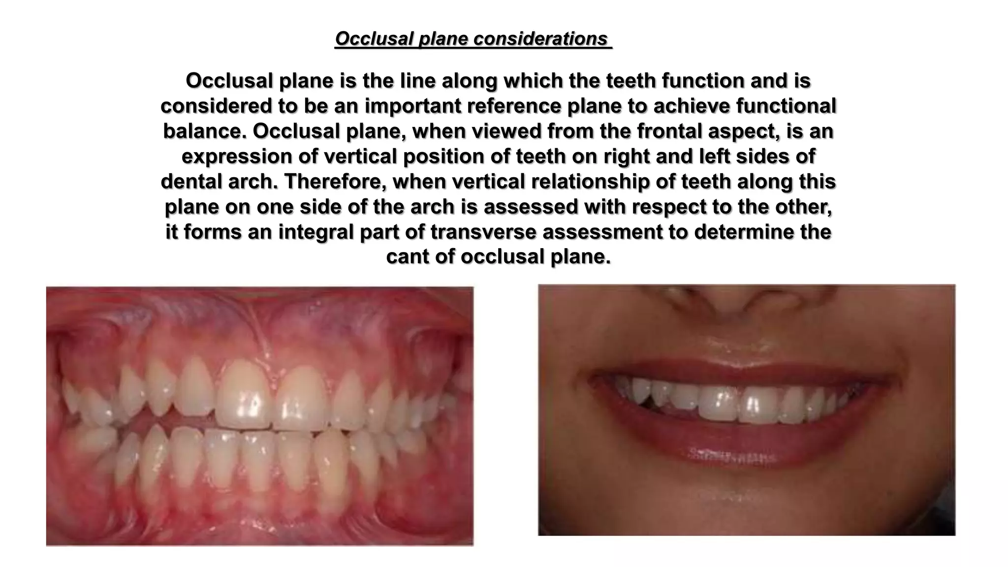 Transverse discrepancies | PPTX