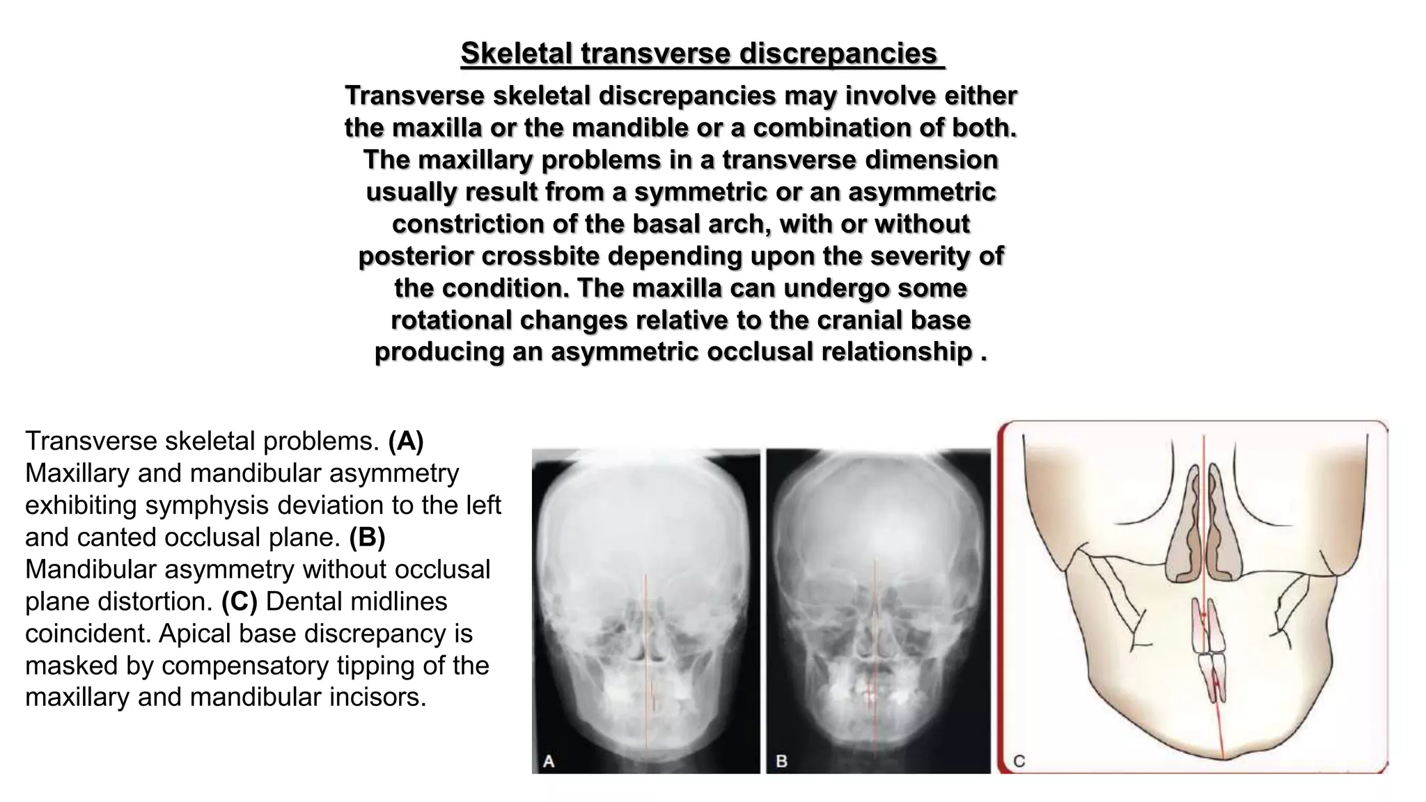Transverse discrepancies | PPTX