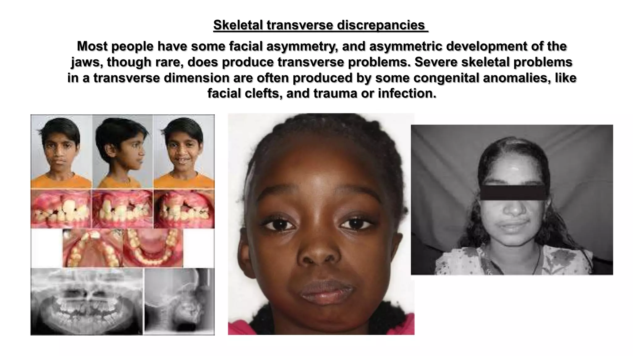 Transverse discrepancies | PPTX